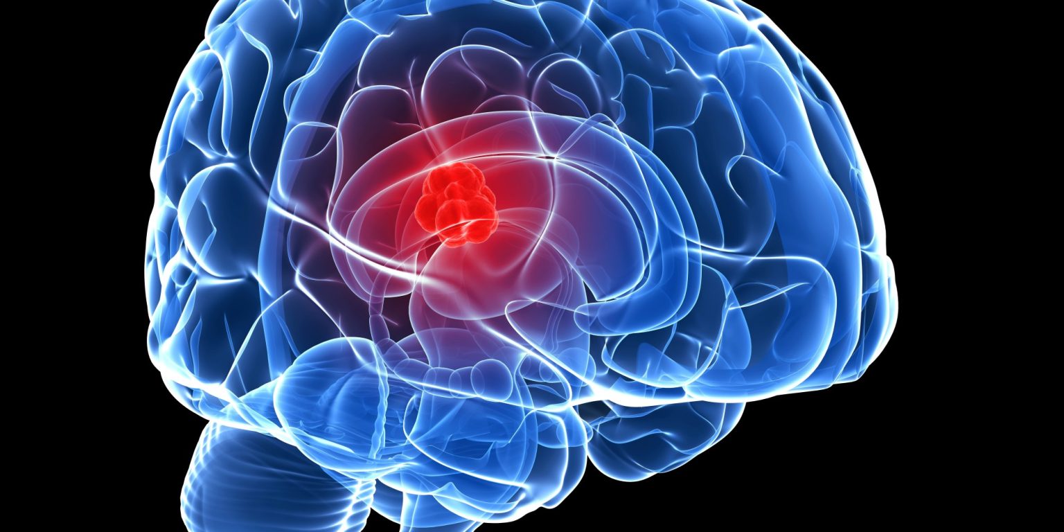 Symptoms of Brain Tumors - Denvax