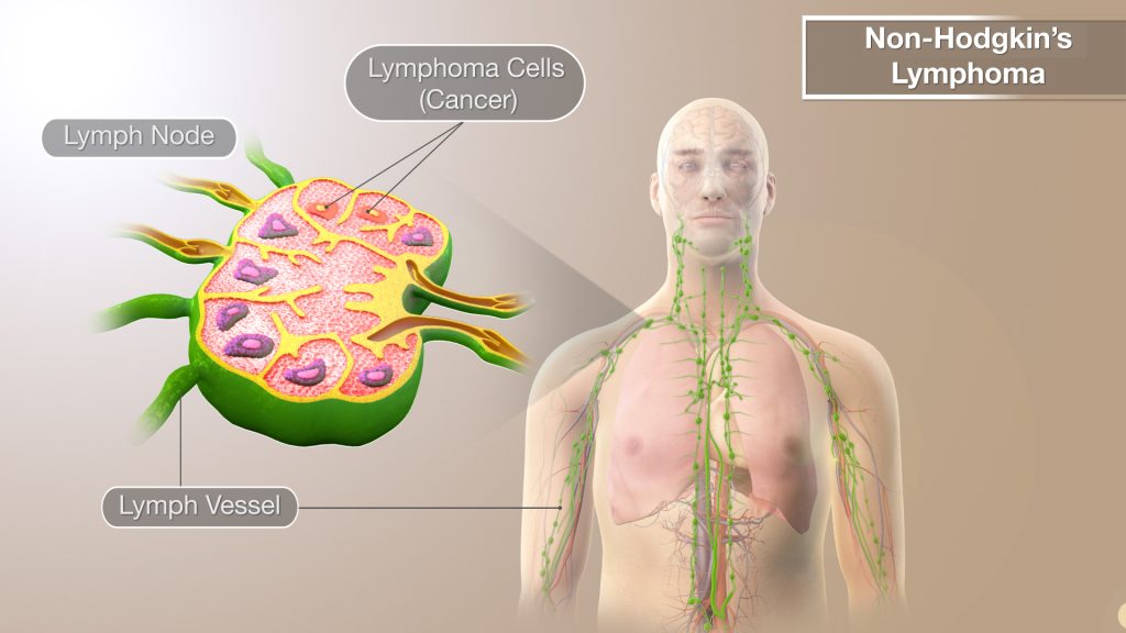 Is Your Rash a Sign of Lymphoma? Symptoms & Treatment