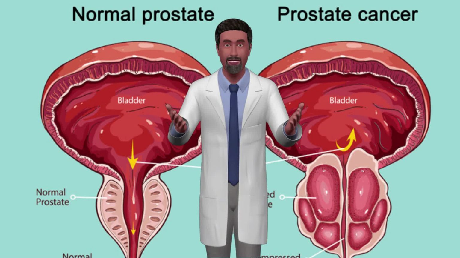 Gleason Score in Prostate Cancer:: Stages & Treatment Guide